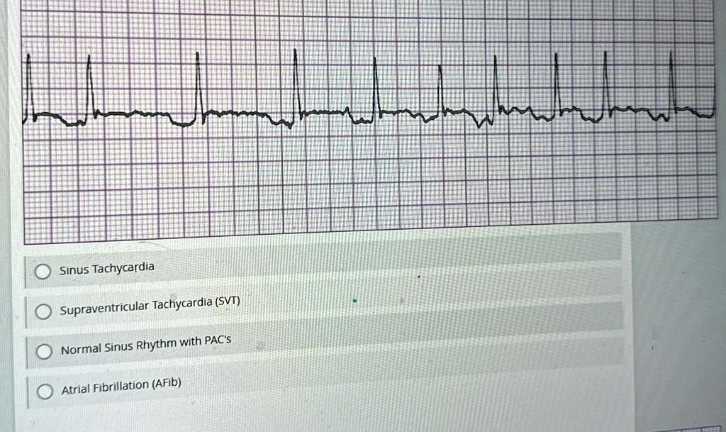 sinus tachycardia supraventricular tachycardia svt normal sinus rhythm ...