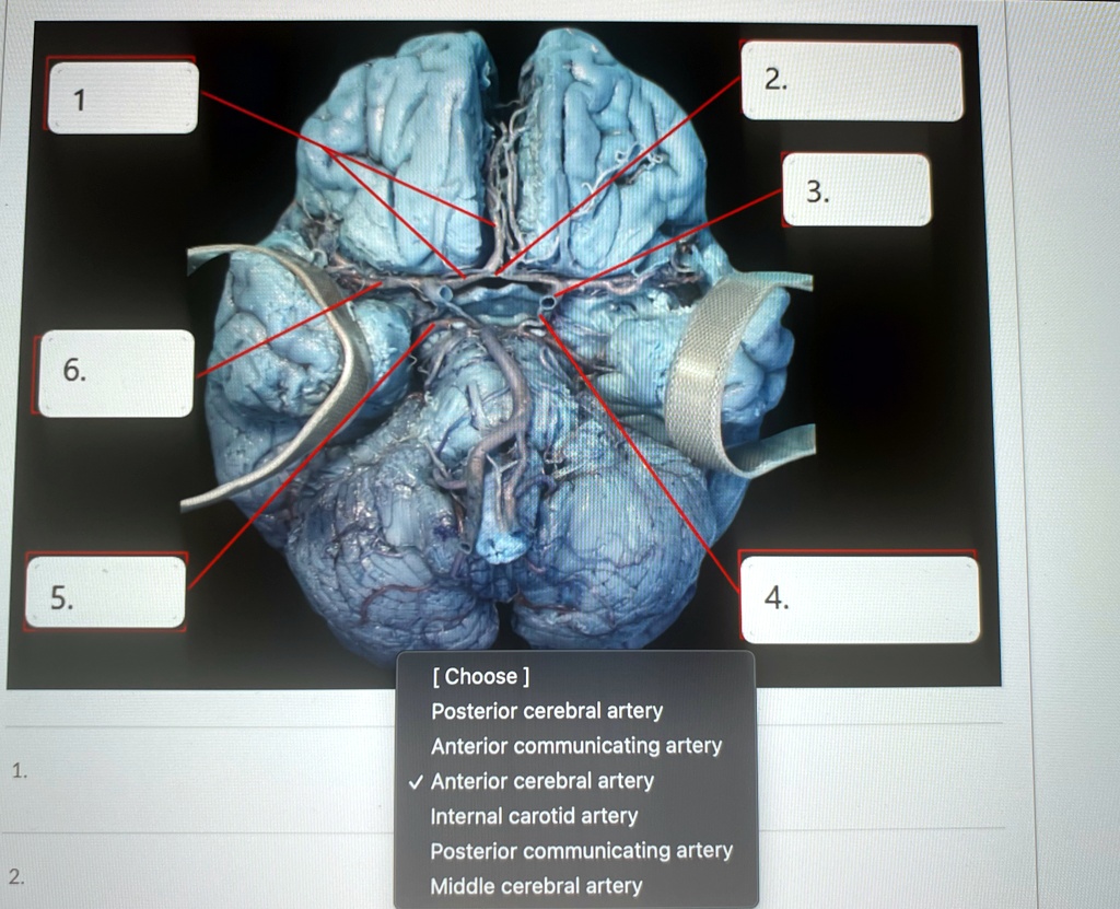 1. 2. 1 6. 5. [Choose ] Posterior cerebral artery Anterior ...