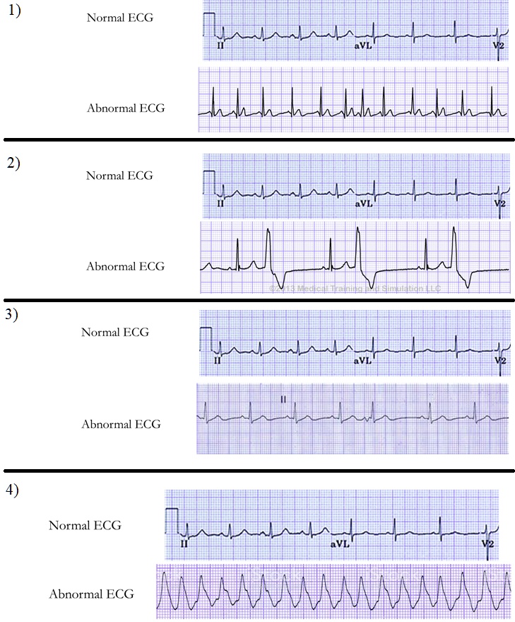 Based On The Abnormal Ecg Shown Below What Antiarrhythmic Drug Would