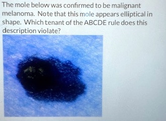 SOLVED: The mole below was confirmed to be malignant melanoma. Note ...