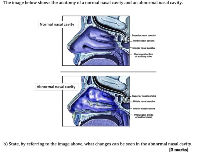 The image below shows the anatomy of a normal nasal cavity and an ...