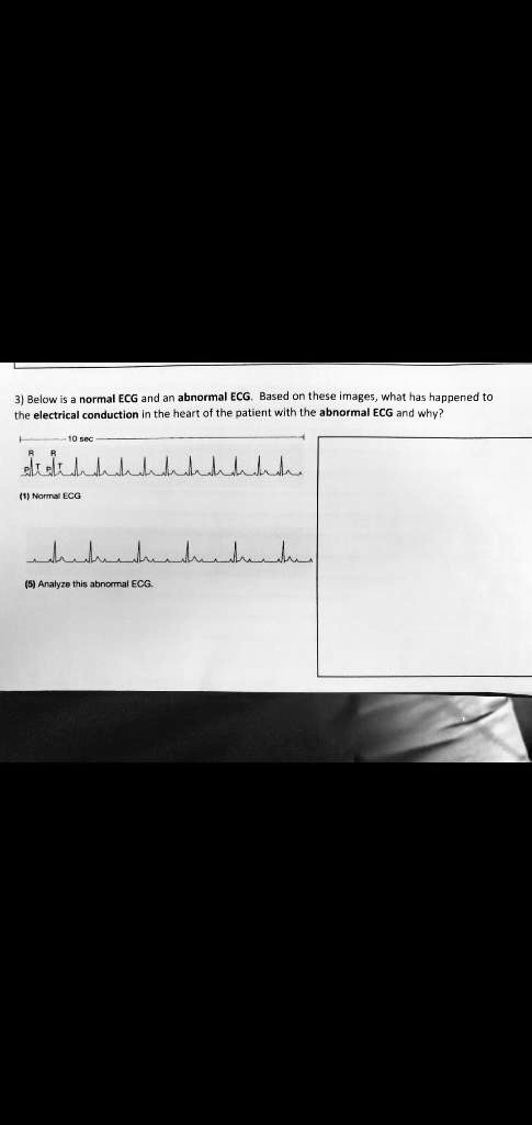 Solved Please Help Thank You 3 Belowis A Normal Ecg And An Abnormal Ecg Based On These