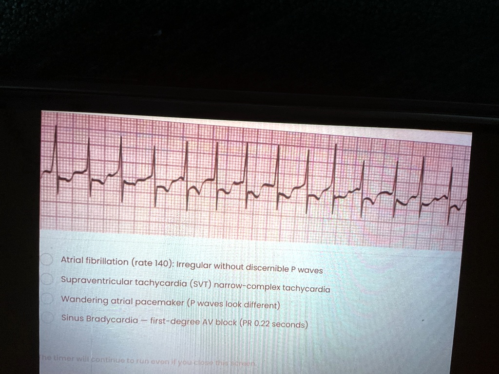 atrial fibrillation rate 140 irregular without discernible p waves ...