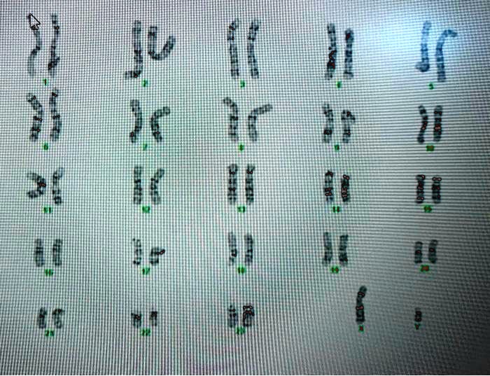 SOLVED: Examine the following karyotype CAREFULLY and select the ...