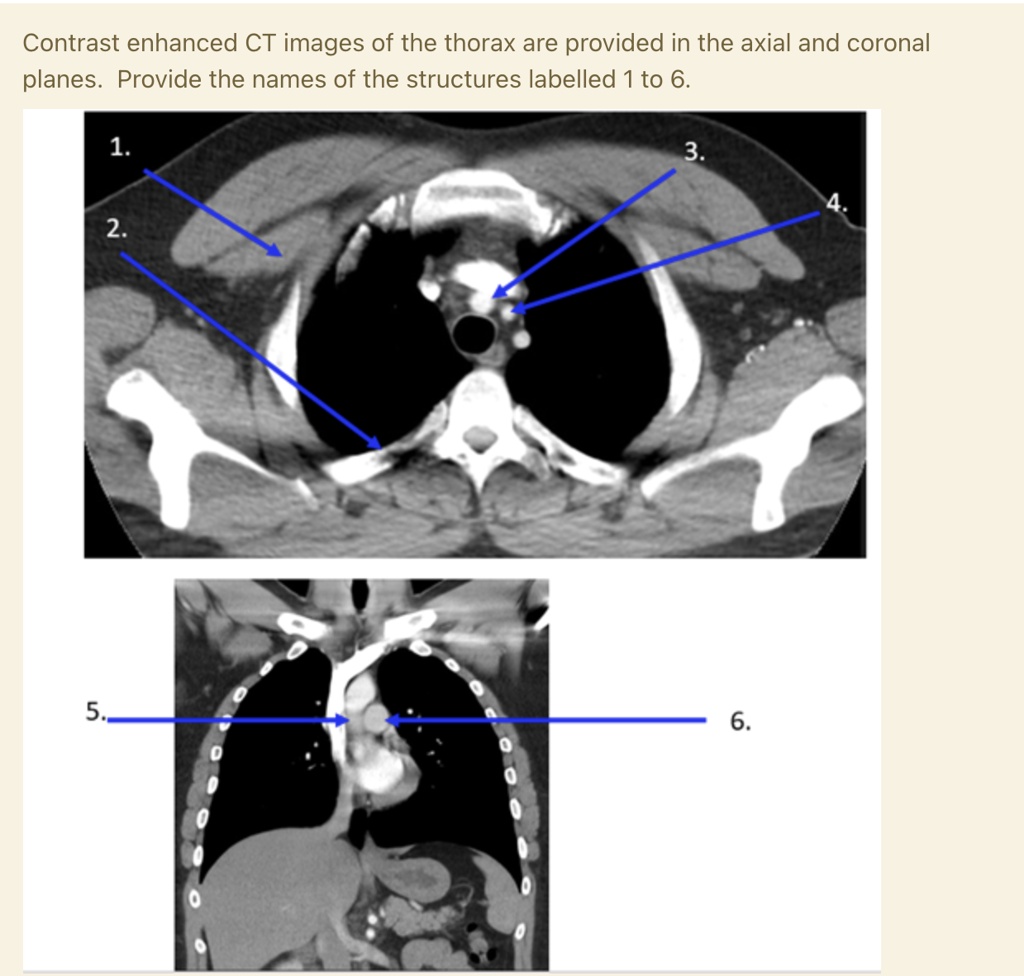 Contrast enhanced CT images of the thorax are provided in the axial and ...