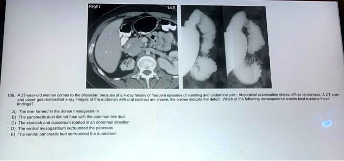 finding a the fer formed in the dorsal mesogastrium b the pancreatic ...