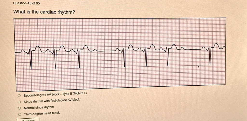 question 45 of 65 what is the cardiac rhythm second degree av block ...