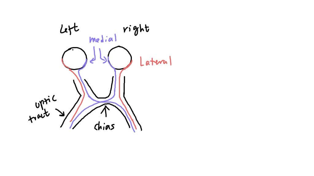 SOLVED: What is the effect of a lesion in the left optic tract ...