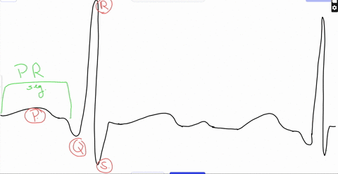 Given the leads below, draw a to-scale graph of aVR. Label...