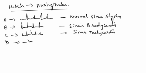sinus tachycardia supraventricular tachycardia svt normal sinus rhythm ...
