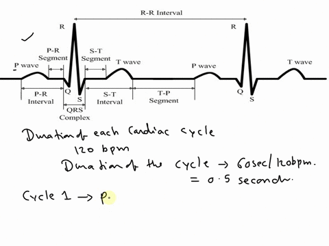 3. Draw two ECG waveforms (P to T) that represent someone...
