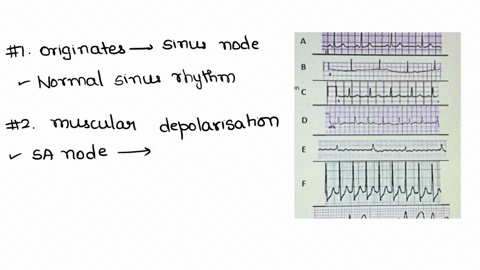 SOLVED:(Fig. 4.1 CANT COPY). What does the ECG in Fig. 4.1 show? A ...