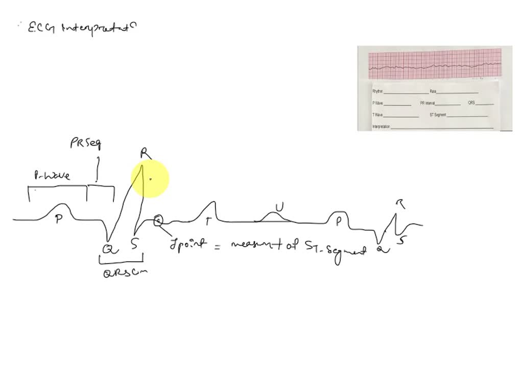 SOLVED: Looking for help for this. Lead: Ventricular Rate: Atrial Rate ...