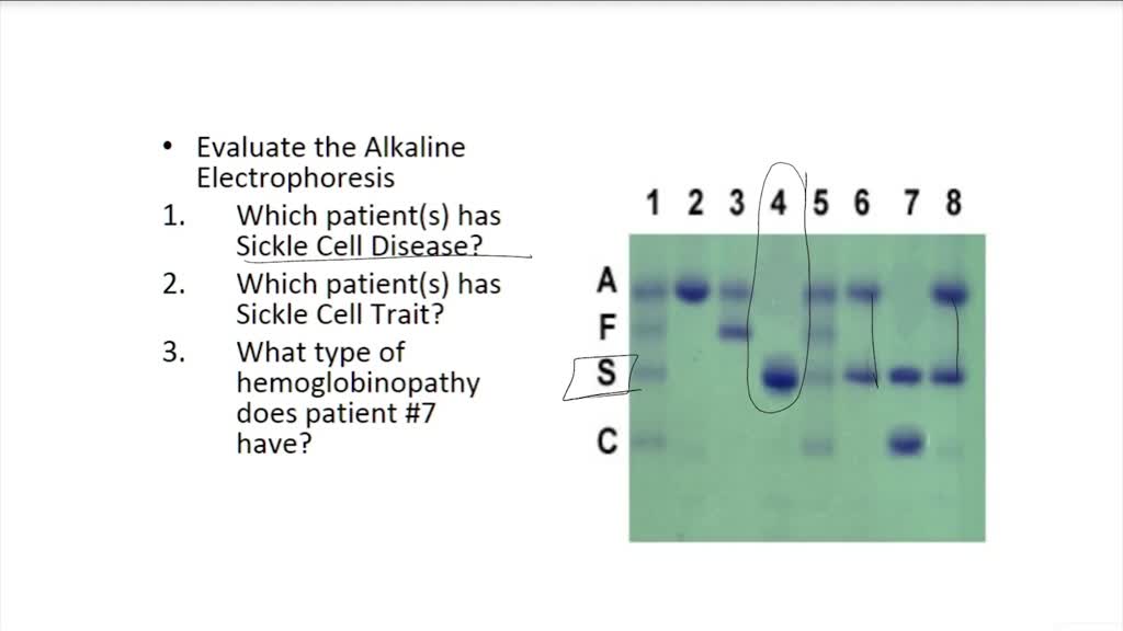 Solved Evaluate The Alkaline Electrophoresis 1 Which Patients Has Sickle Cell Disease 2