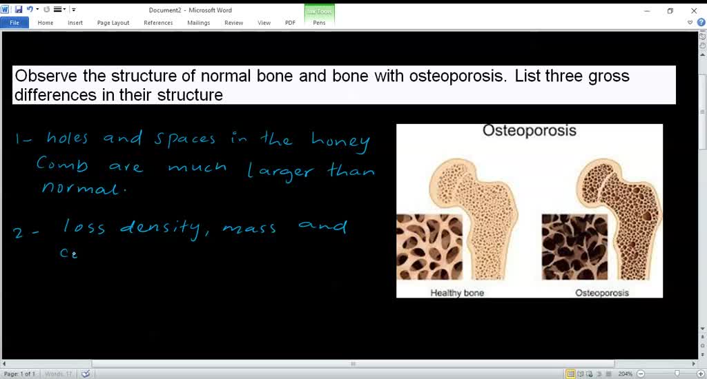 SOLVED: Observe the structure of normal bone and bone with osteoporosis ...