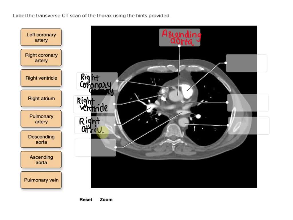 SOLVED: 'Label the coronary arteries in an anterior view of the heart ...