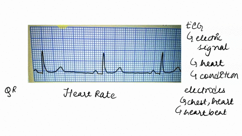 Tachycardia is a fast heart rate and is defined as a resting...
