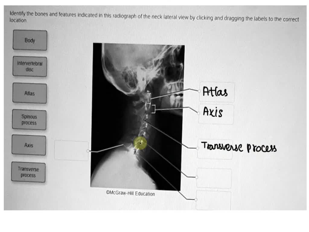 SOLVED: Label the bone features (bone markings) of the os coxa (hip bone) lateral view by ...