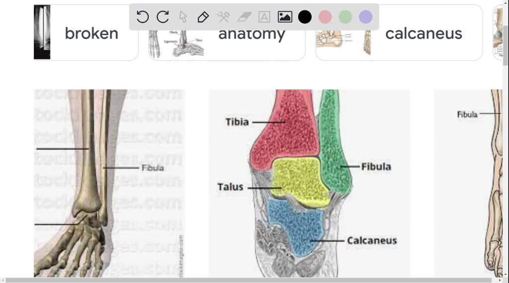 SOLVED: What do the femoral condyles meet with on the tibia?