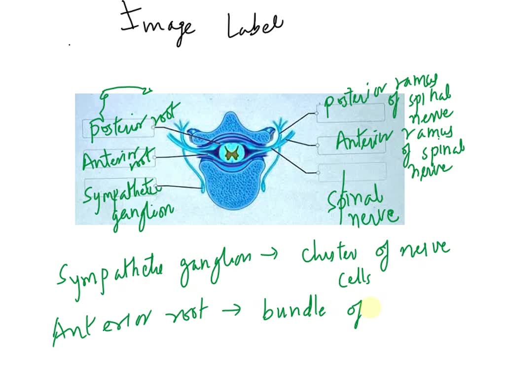 SOLVED: Epidural injection Vertebral ligaments Vertebral bones Epidural ...