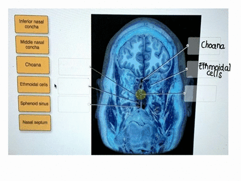 Coronal view of the nasal cavity view the illustration and...