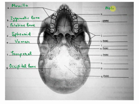 Label the anatomical features of the skull. Carotid...