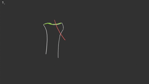 SOLVED:Watch this video (http://openstaxcollege.org/I/ fractures) to see how fractures of the ...