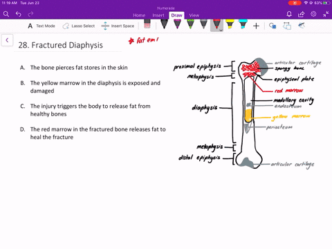 SOLVED:A fracture can be both ______. a. open and closed b. open and ...