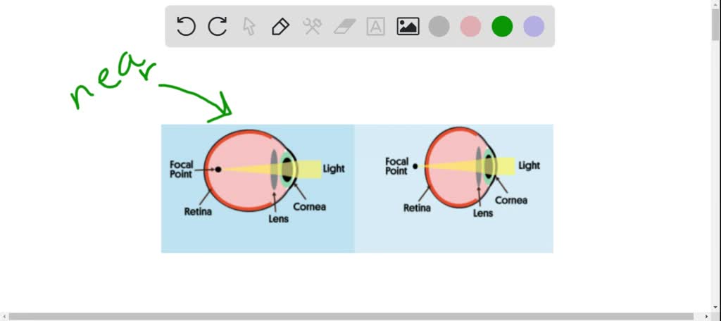 SOLVED:The condition of farsightedness, or hyperopia, can be corrected ...
