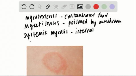 SOLVED:A fungal infection that affects nails and skin is classified as ...