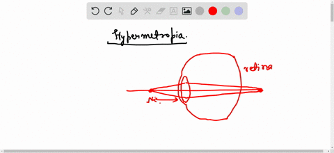 SOLVED:Make a diagram to show how hypermetropia is corrected. The near ...