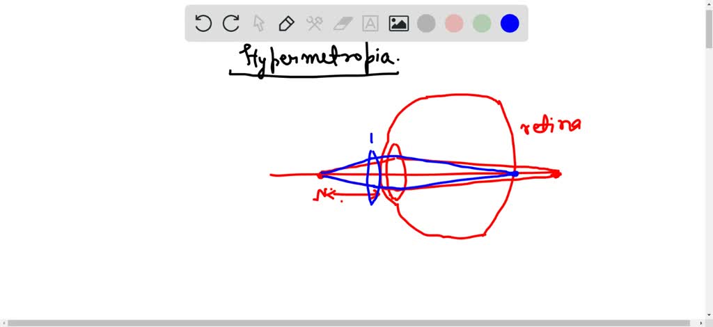 SOLVED:Make a diagram to show how hypermetropia is corrected. The near ...