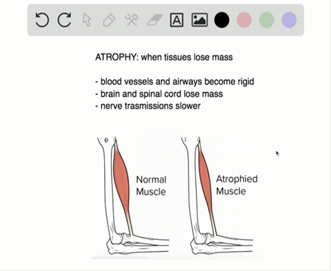 SOLVED:Atrophy refers to . a. loss of elasticity b. loss of mass c ...